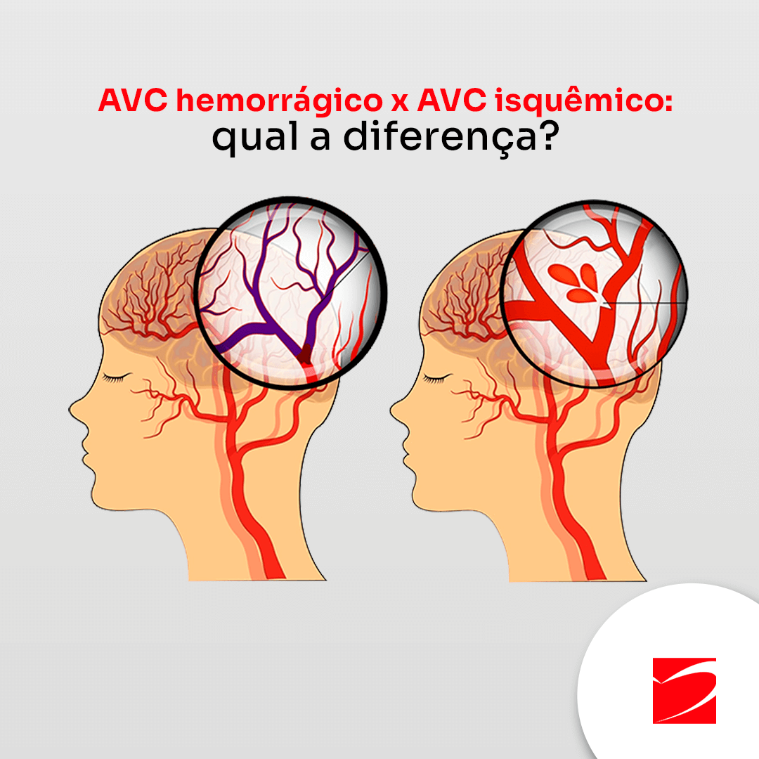 Entenda o AVC - ICOR - Instituto do Coração de Santa Maria